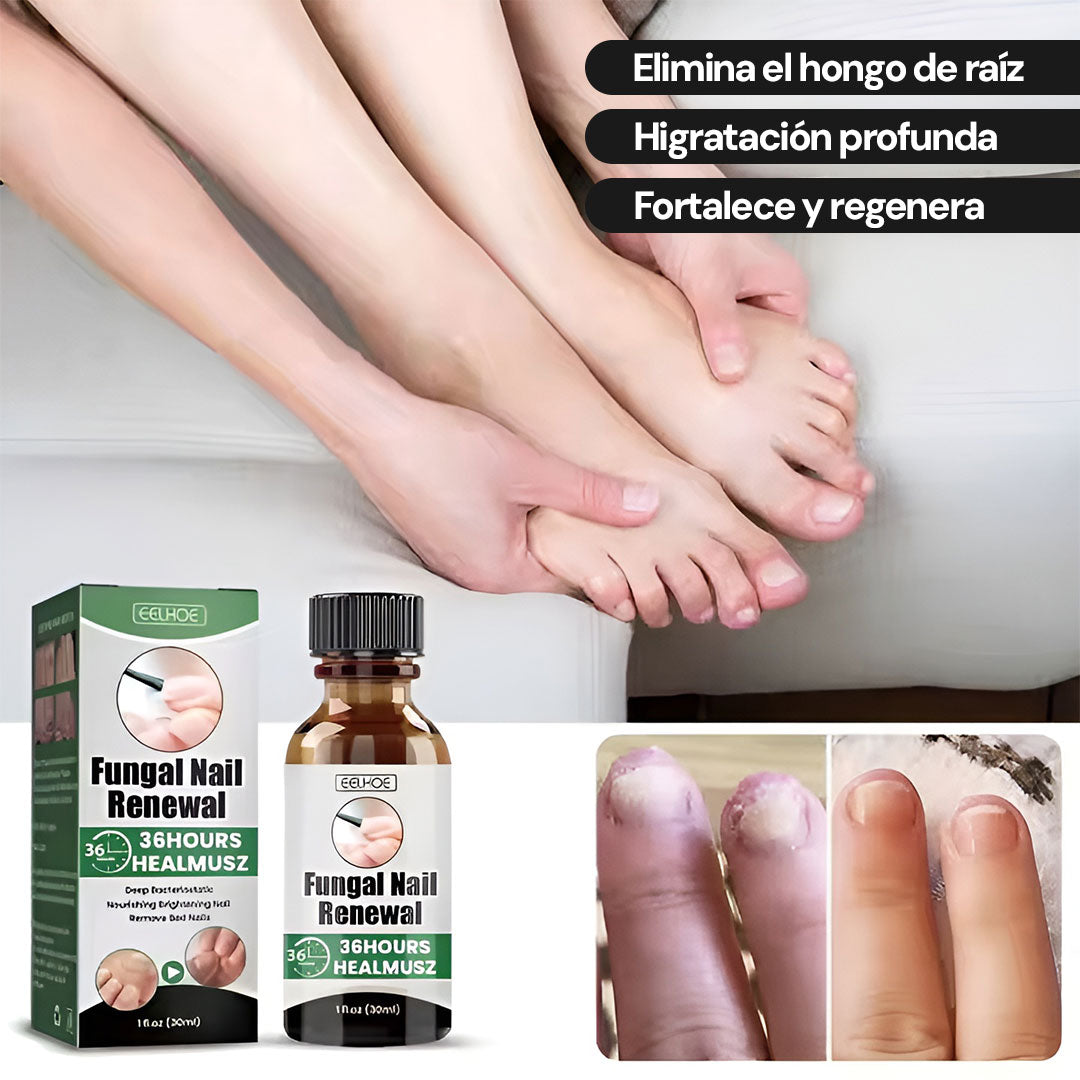 Nail Cure Pro | Tratamiento avanzado para hongos en las uñas – Tienda ...